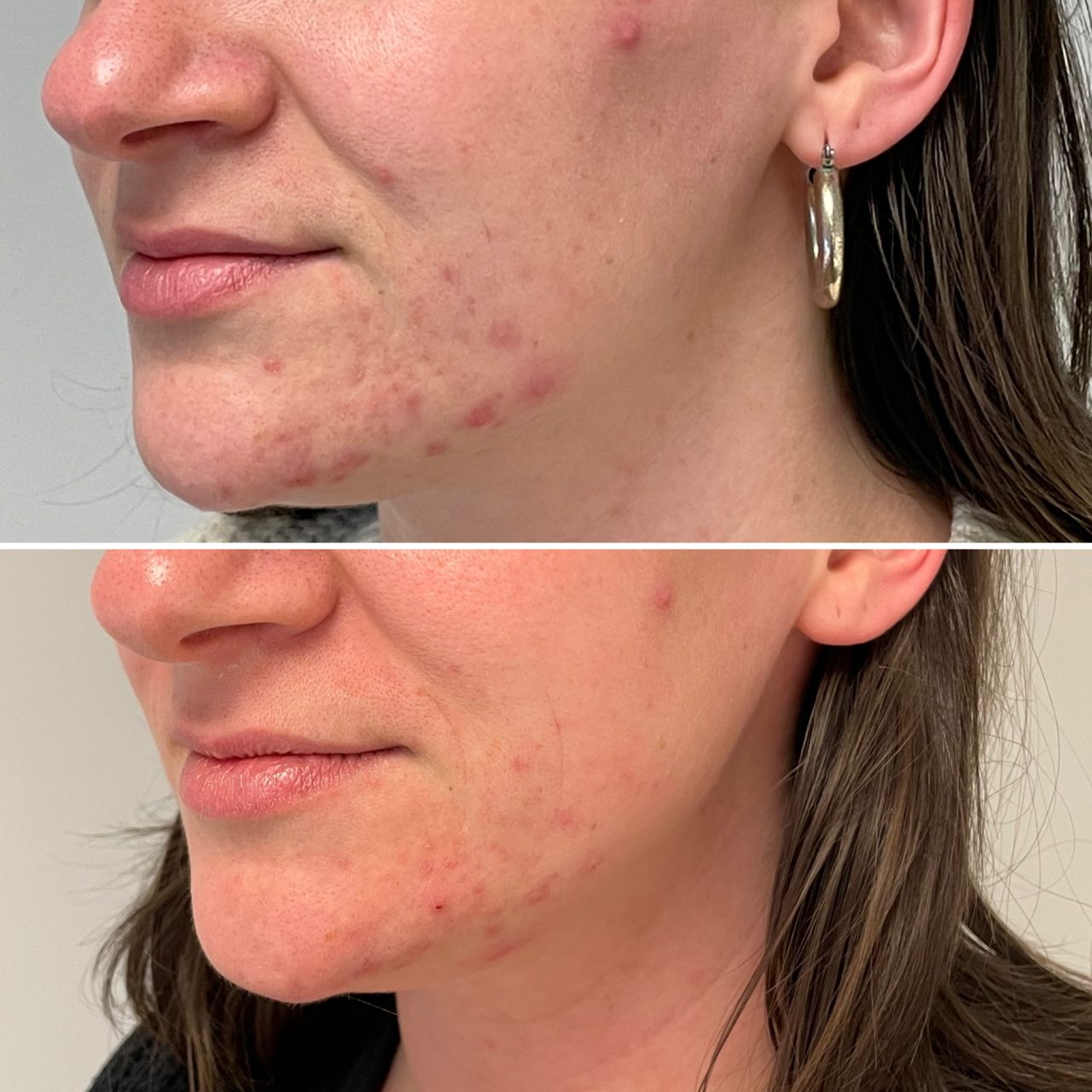 Seattle Active Acne Treatments, Natural Healing Approach